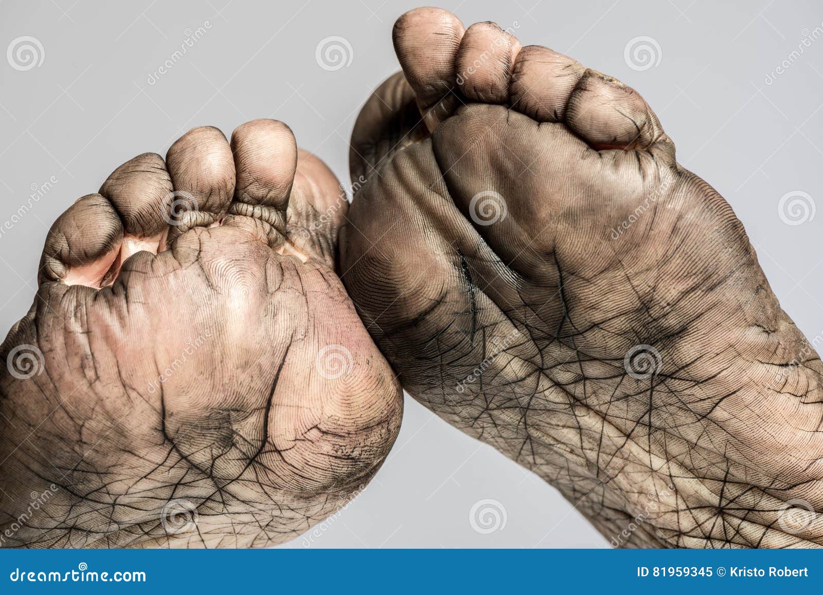 Foot Skin Is Dry And Cracked On White Background Royalty-Free Stock ...