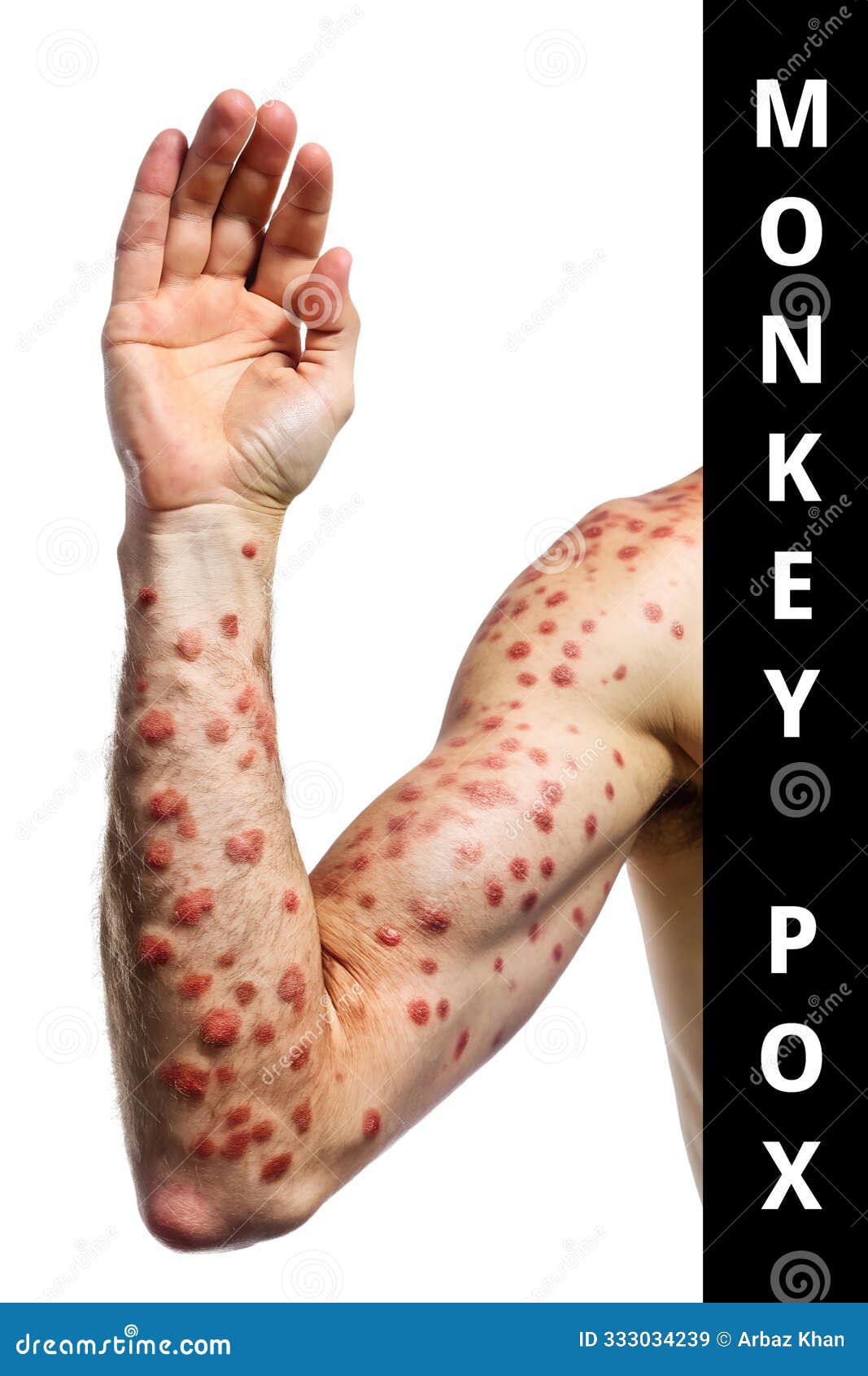 Human Hand Affected by Monkeypox Stock Illustration - Illustration of ...
