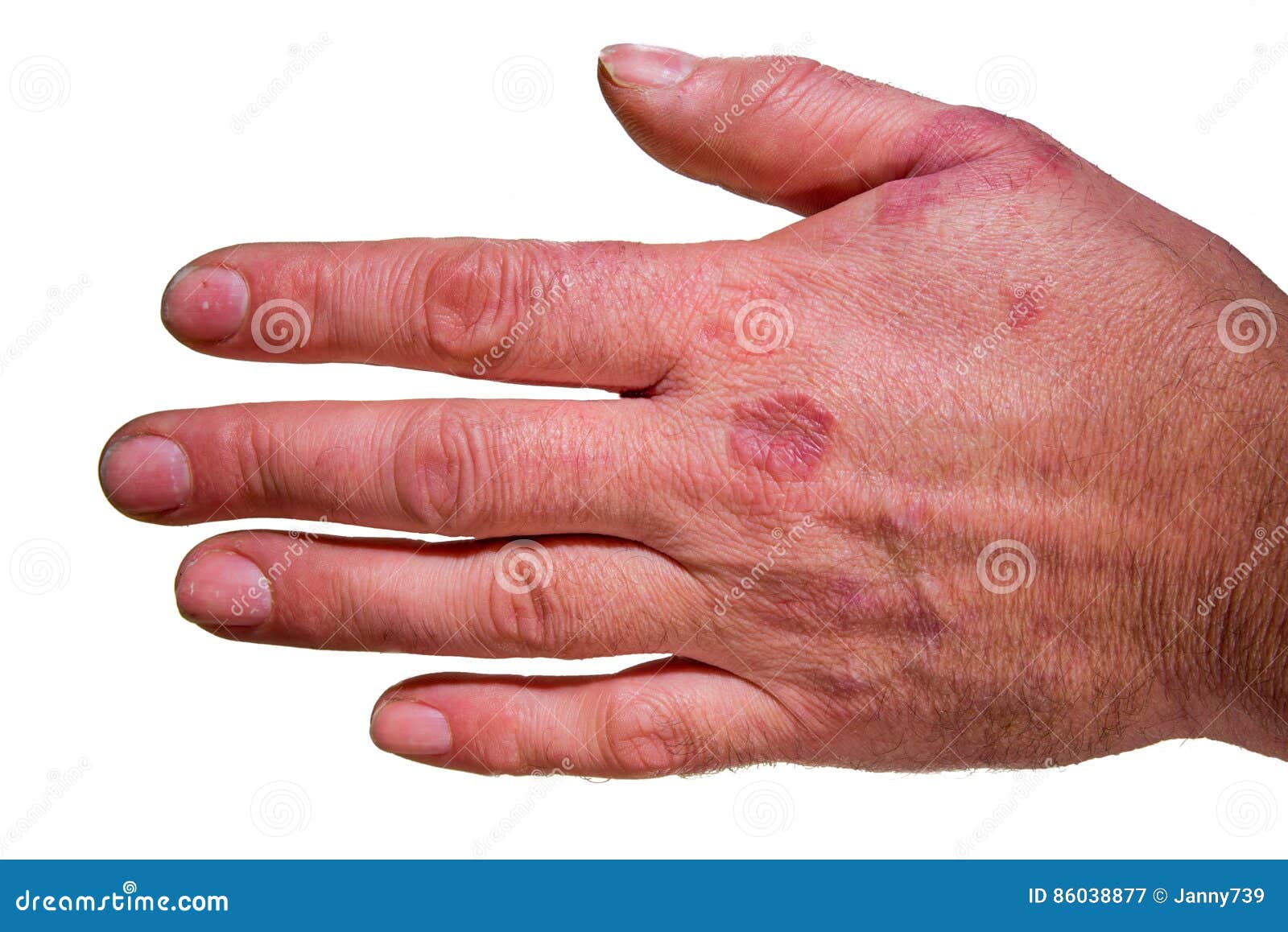 Human Hand with Rash / Eczema Stock Image - Image of reactions, lesions ...