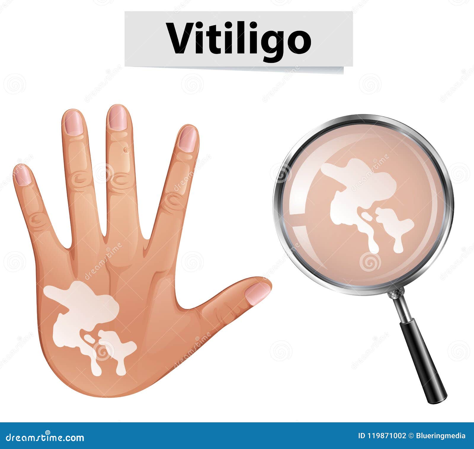 Vitiligo Cartoon Vector | CartoonDealer.com #33694423