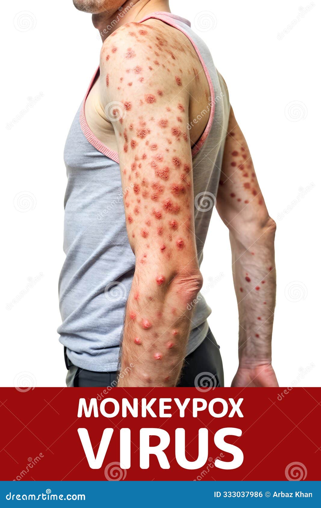 Human Hands Affected by Monkeypox Stock Photo - Image of dermatological ...