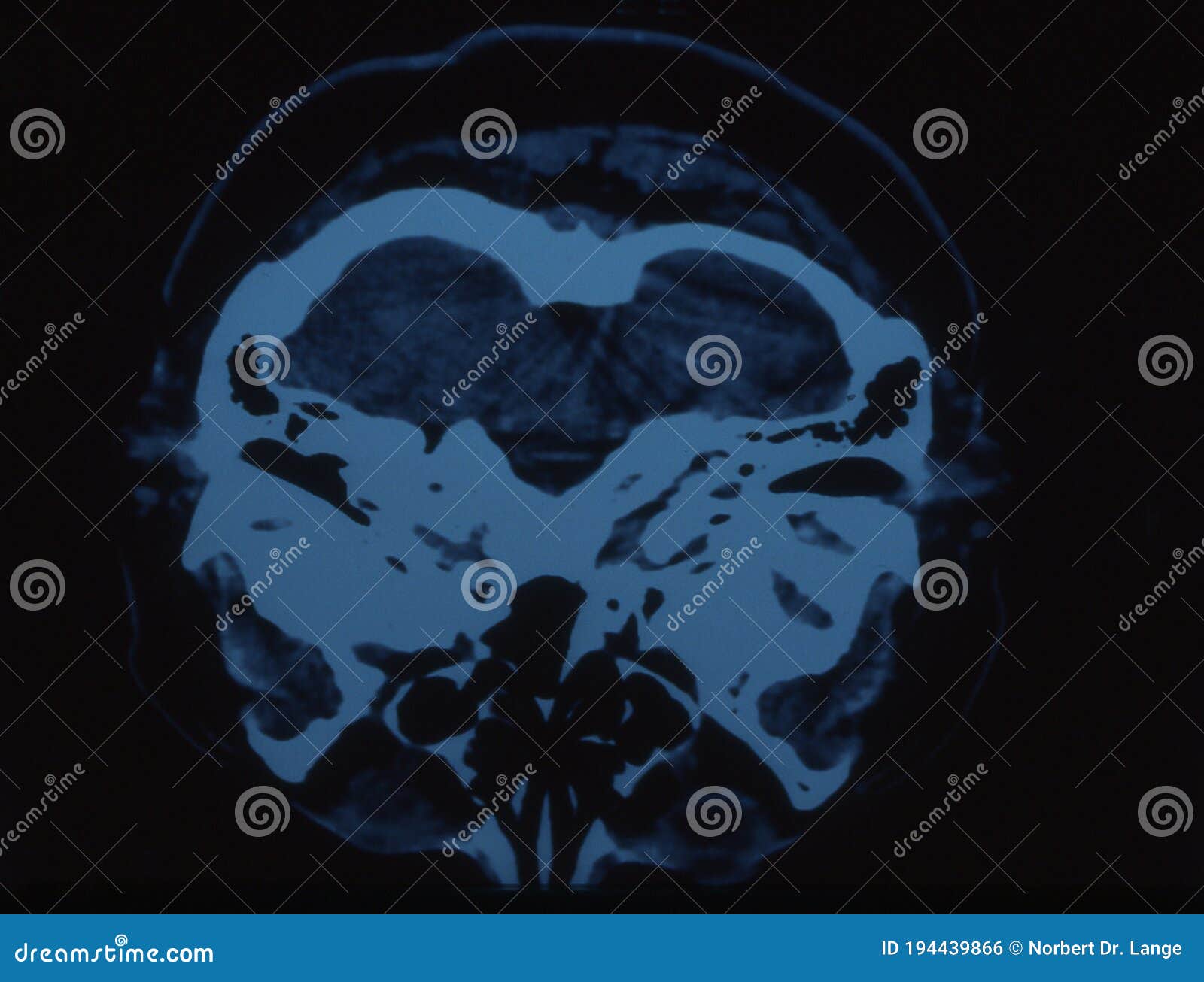 3D Radiograph With Head Injury Royalty-Free Stock Photo | CartoonDealer ...