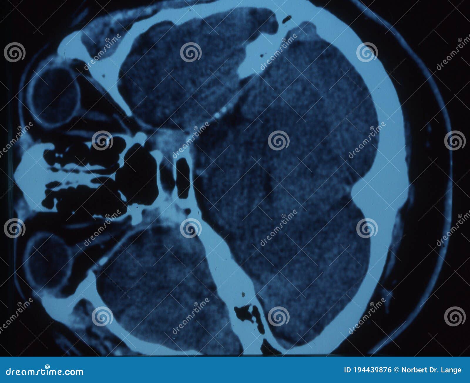 3D Radiograph With Head Injury Stock Image | CartoonDealer.com #9851887
