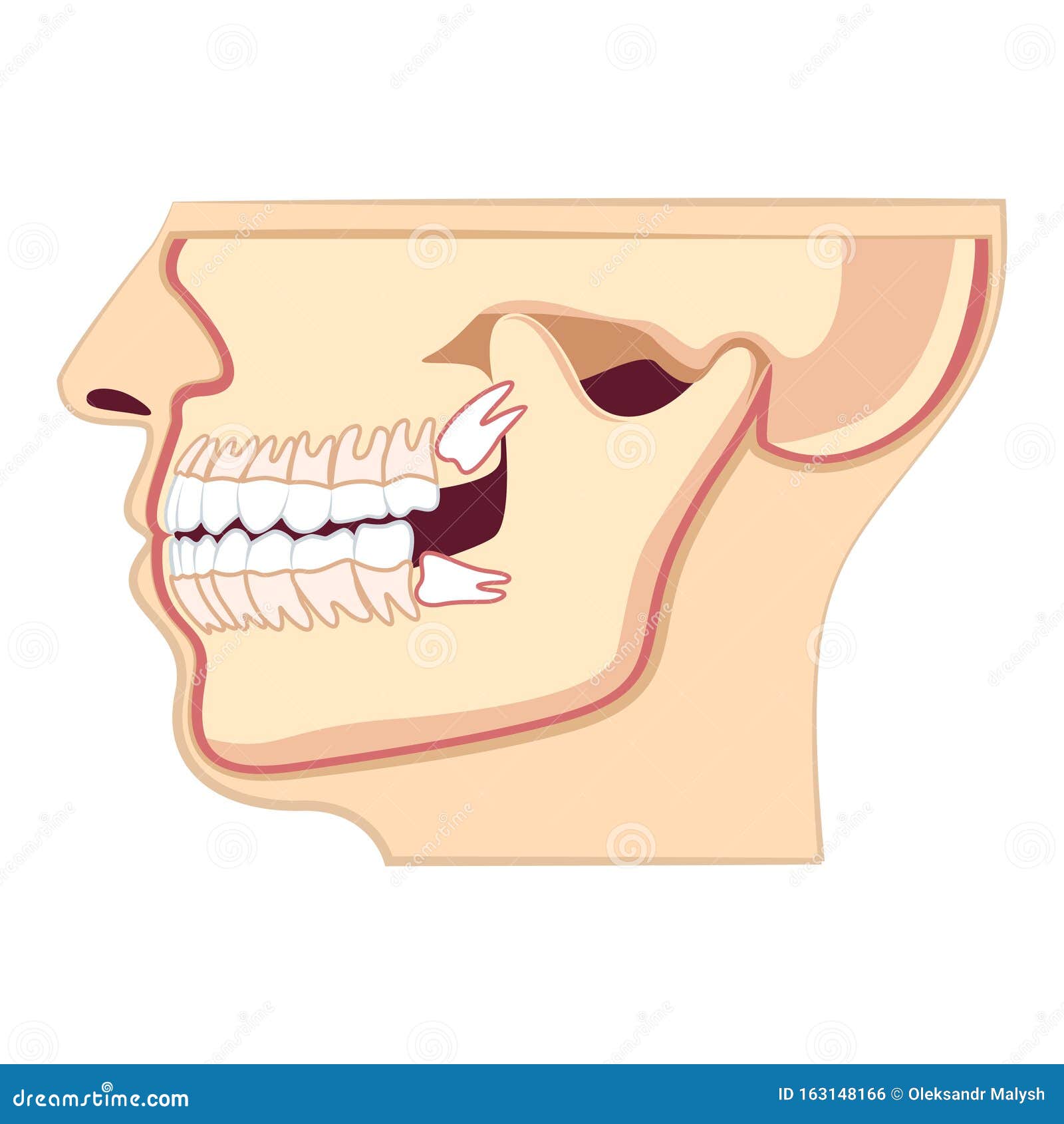 Abnormal Eruption Of Wisdom Tooth. Dental Problems Cartoon Vector ...