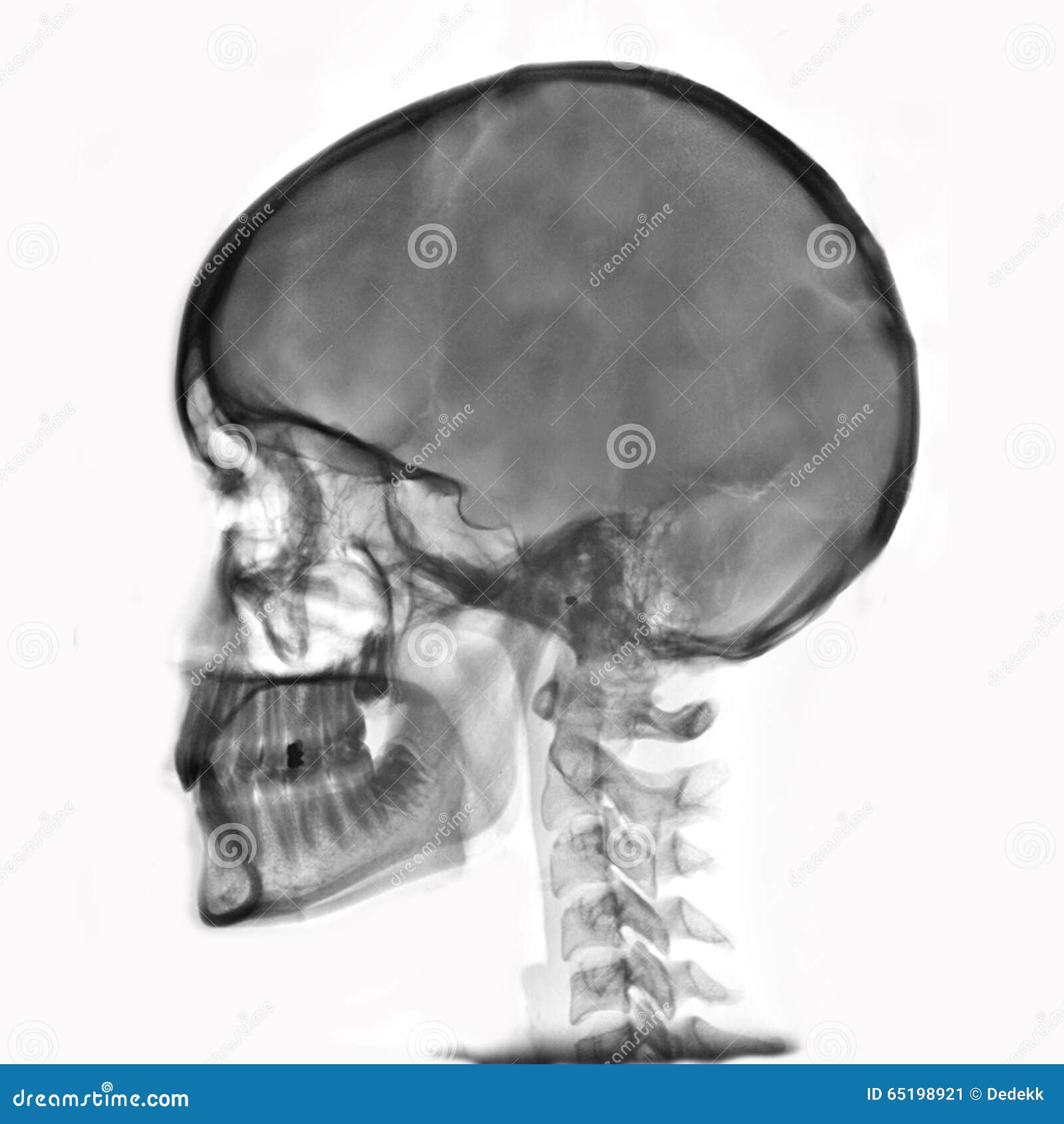 Human head stock image. Image of spinal, medical, hospital - 65198921