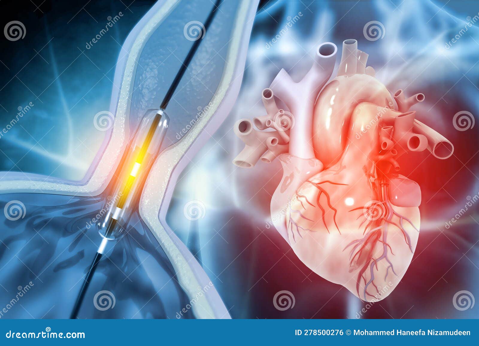 Human Heart with Balloon Angioplasty Stock Illustration - Illustration ...