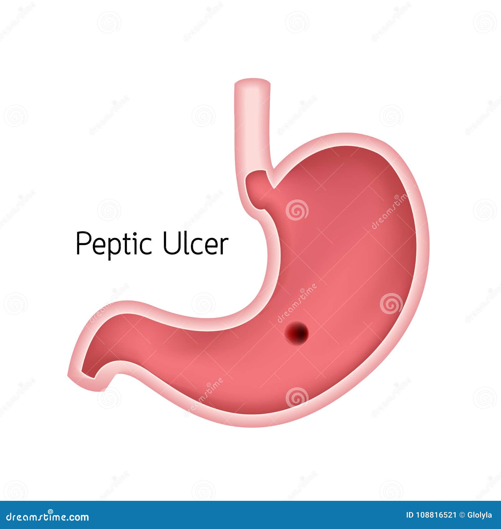 Stomach Peptic Ulcer Detected By Endoscopy Procedure Vector Illustration