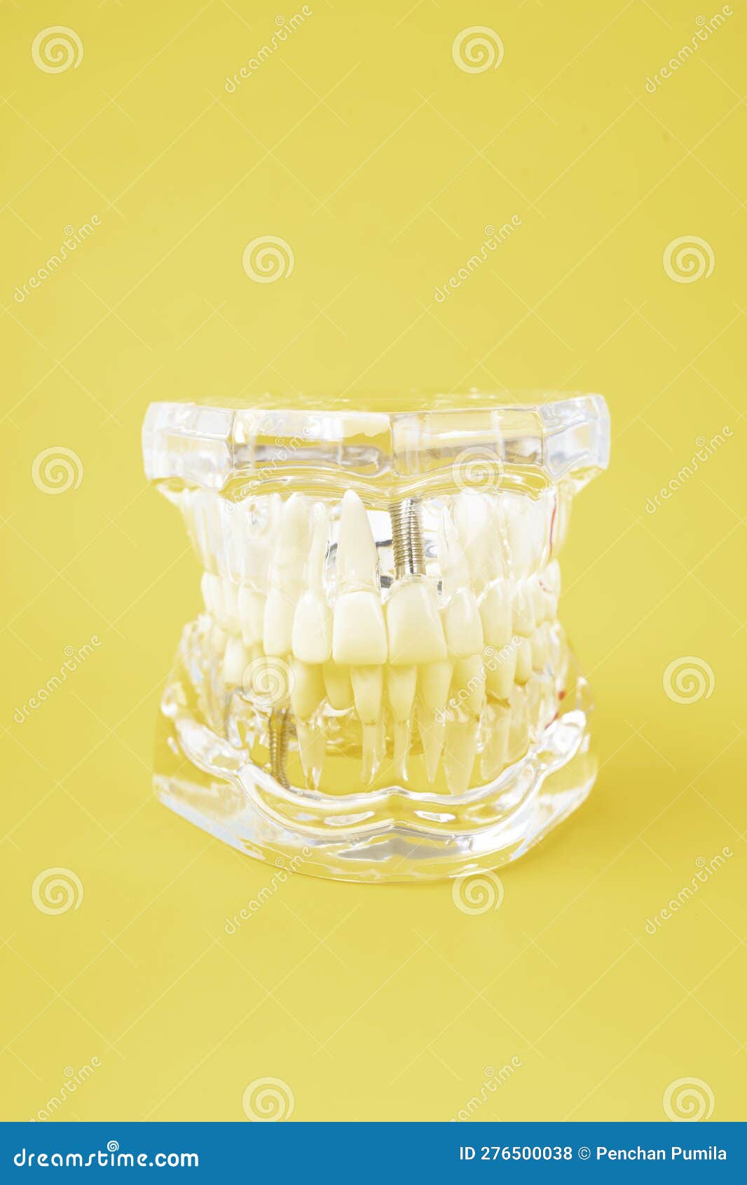 The Human Jaw or Acrylic Dentures Model with Implants on Yellow ...