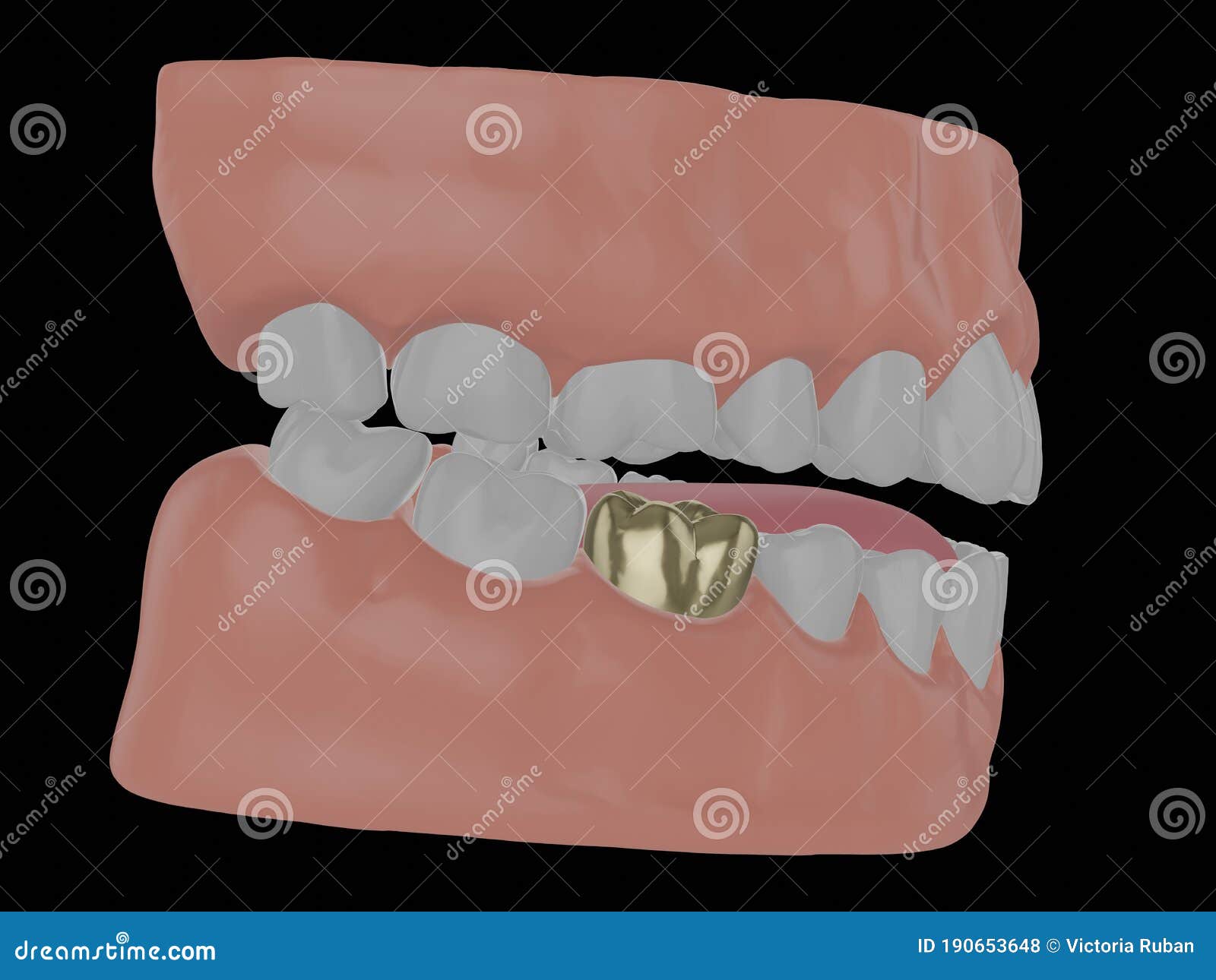 Human jaw with gold tooth stock illustration. Illustration of medical ...