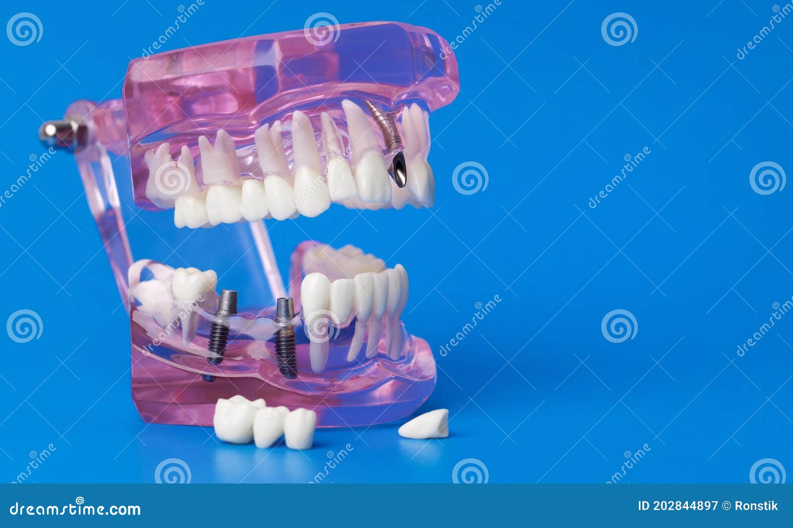 Tooth Model With Caries, Tooth Decay In Dentist`s Office. Healthy Teeth ...