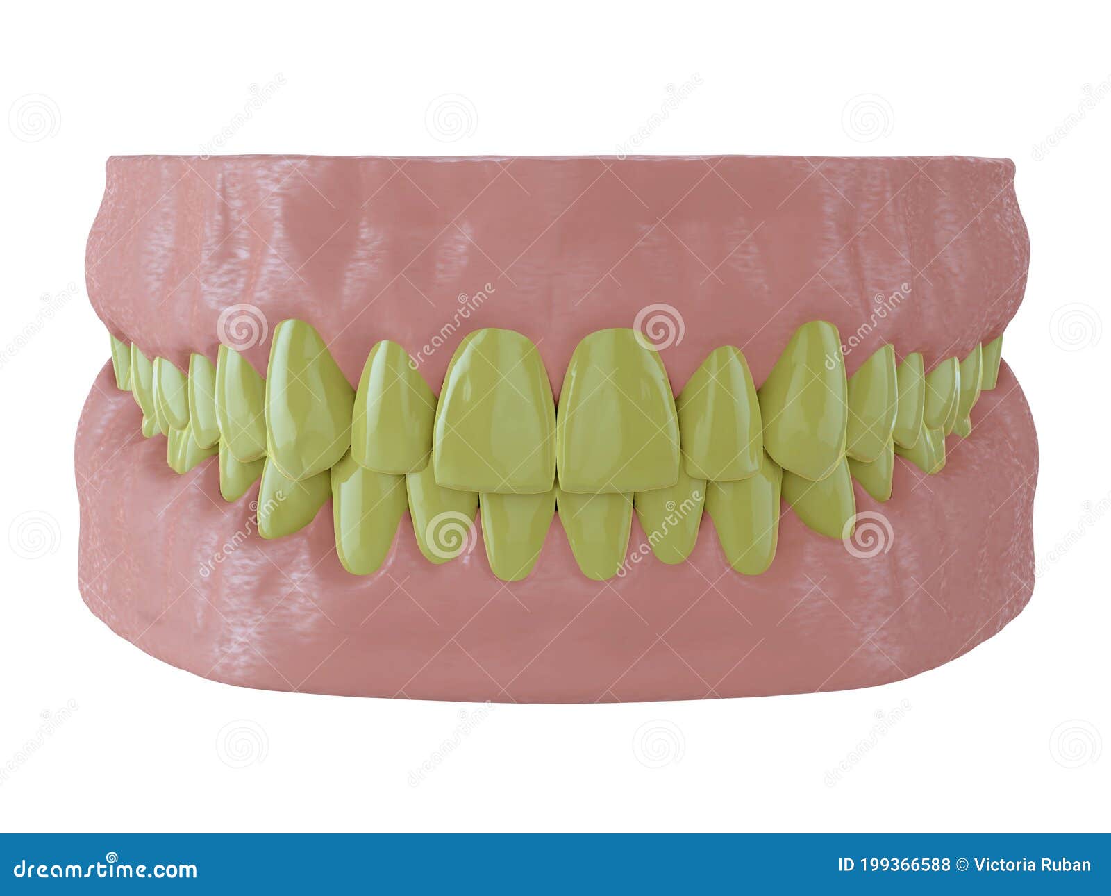 Human Jaw with Yellow Teeth Stock Photo - Illustration of dentition ...