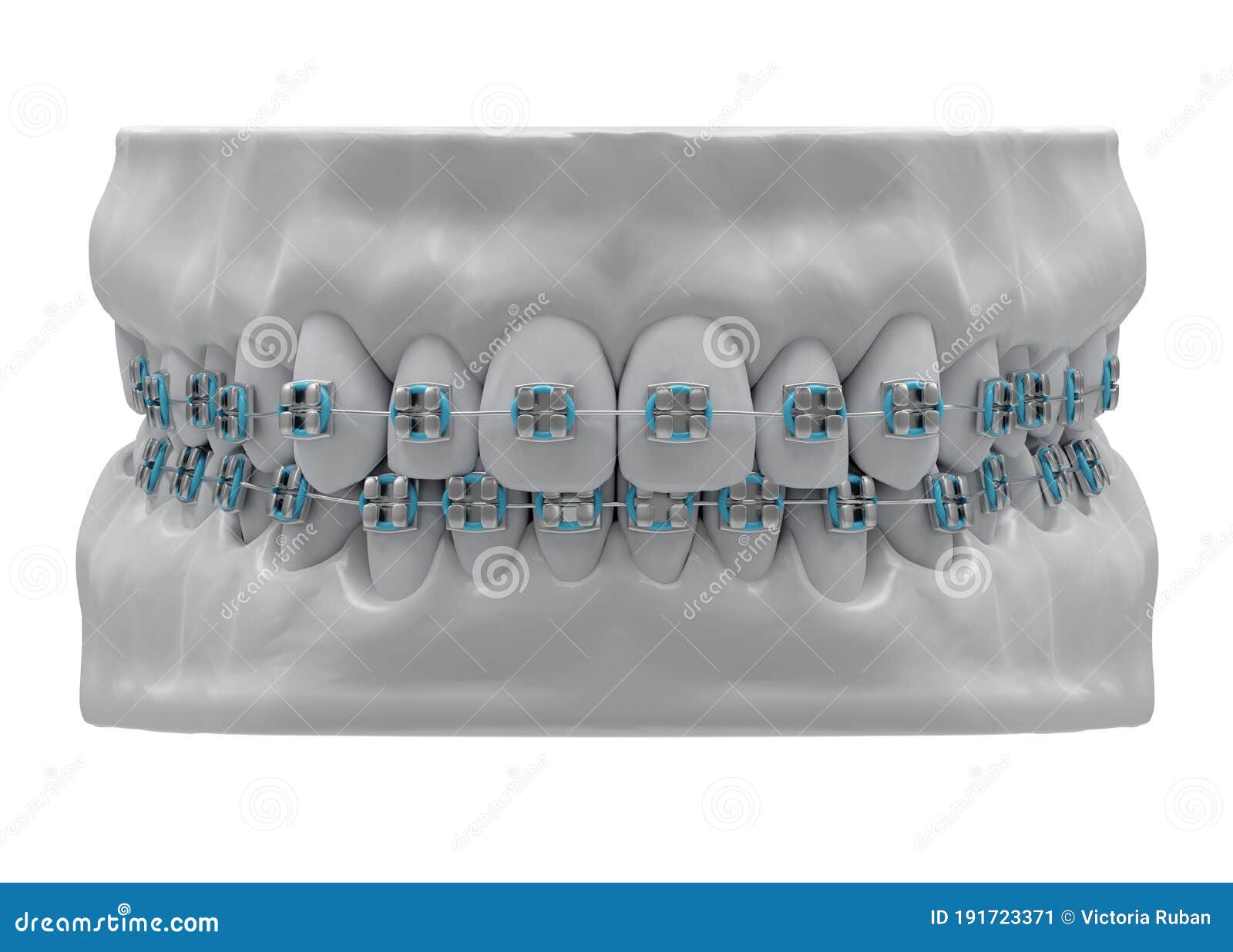 Classic Metal Braces, Front View Stock Illustration - Illustration of ...
