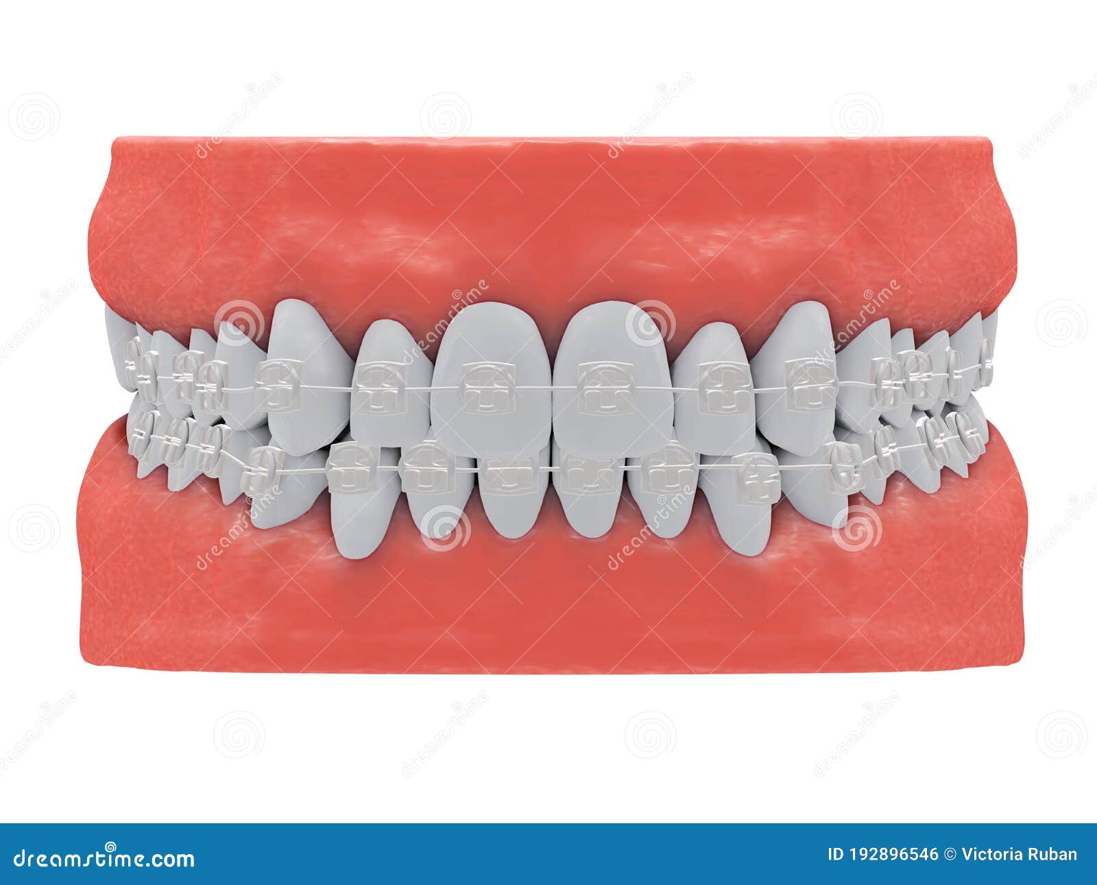 Ceramic Braces Vector. Human Jaw. Dentist, Orthodontist Poster Element ...