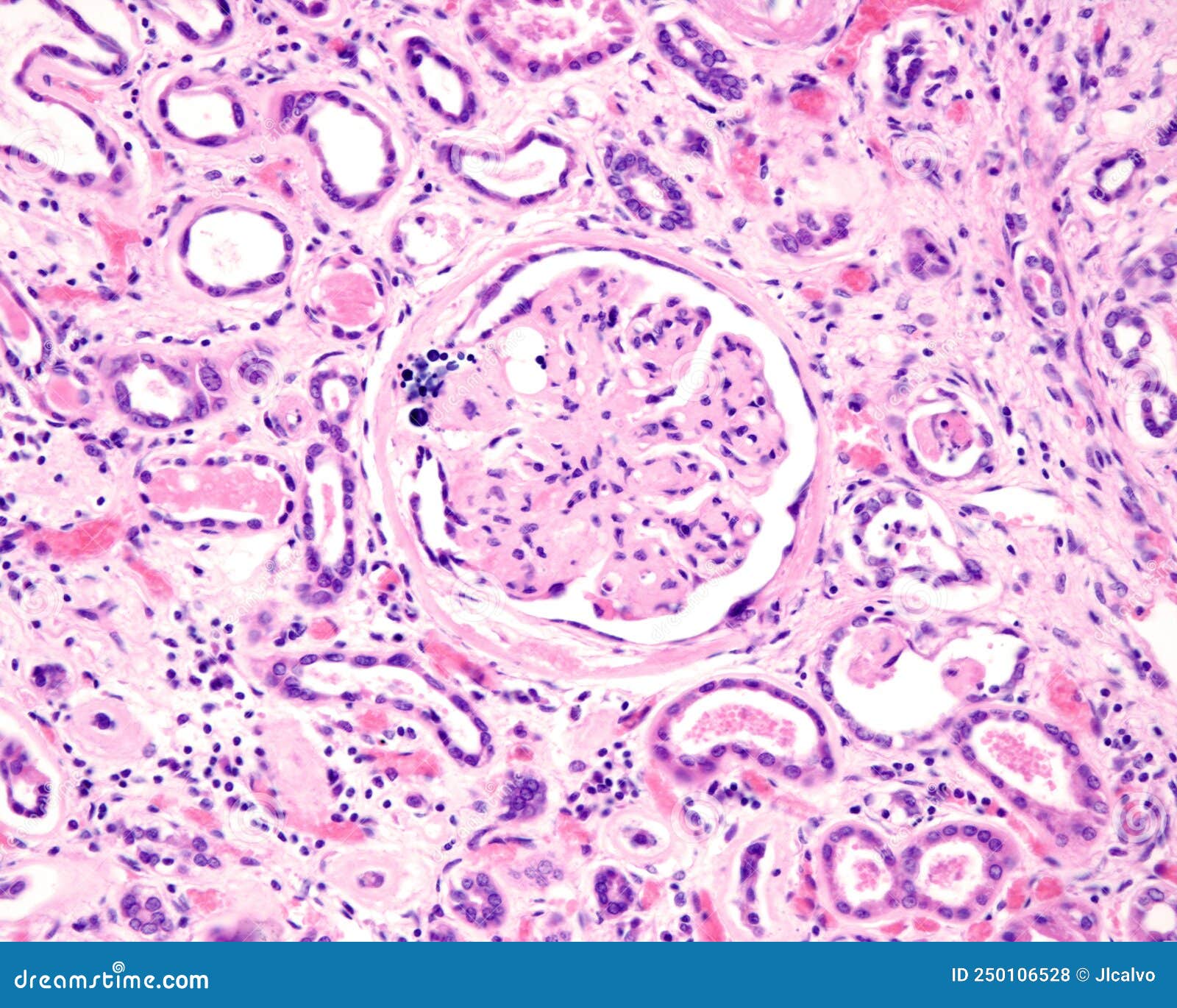 Human Kidney. Diabetic Nephropathy Stock Photo - Image of eosin ...