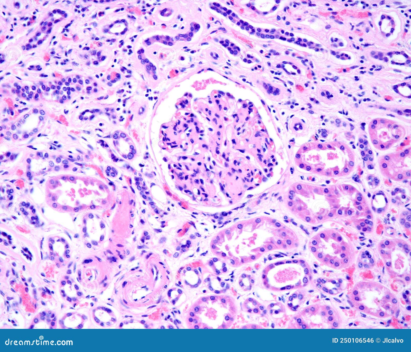 Human Kidney. Diabetic Nephropathy Stock Photo - Image of ...