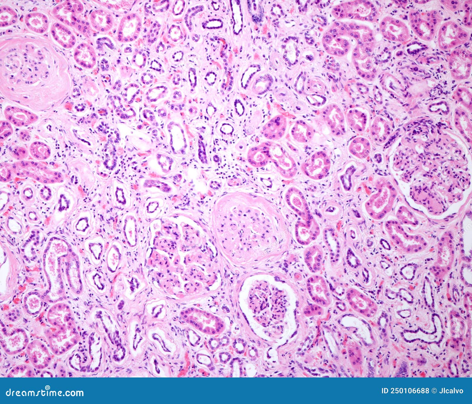 Human Kidney. Diabetic Nephropathy Stock Photo - Image of glycogen ...