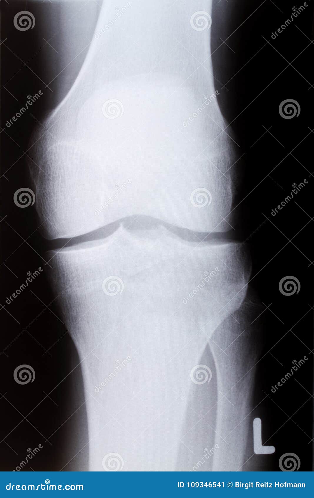 Human knee in front stock image. Image of skeleton, painful - 109346541