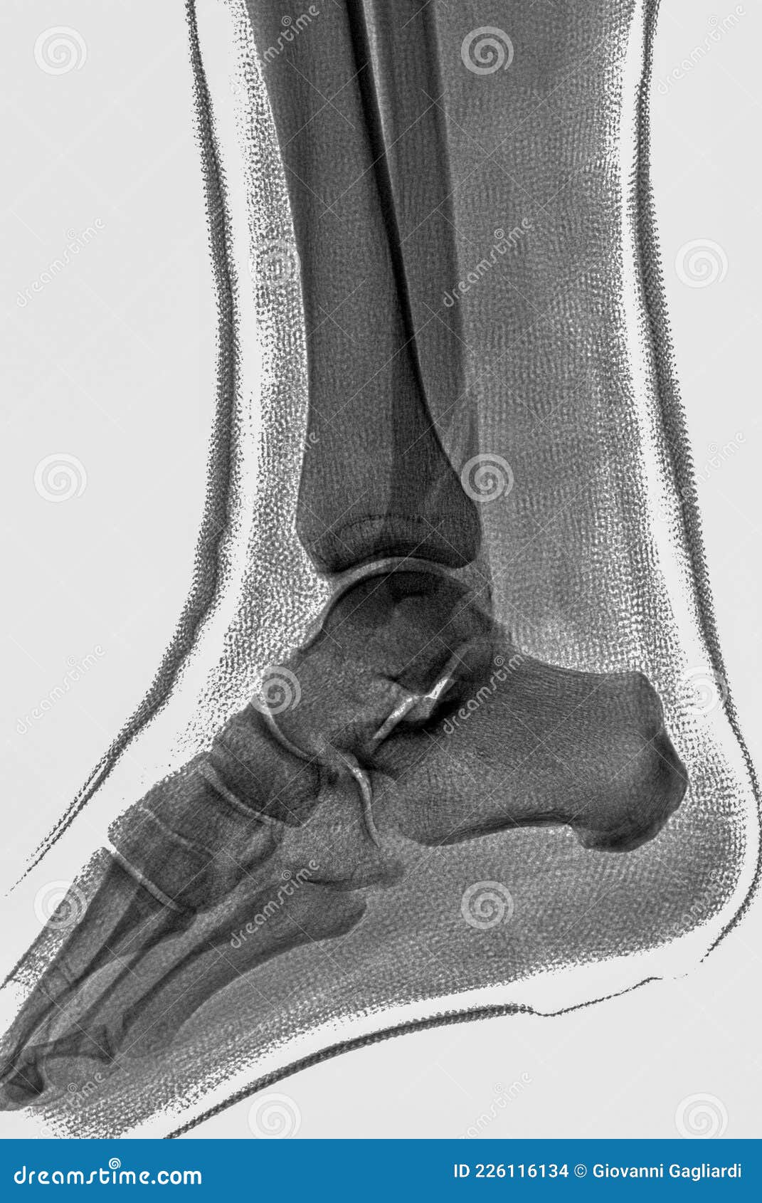 Human Left Foot. X Ray Lateral View Stock Photo - Image of science ...