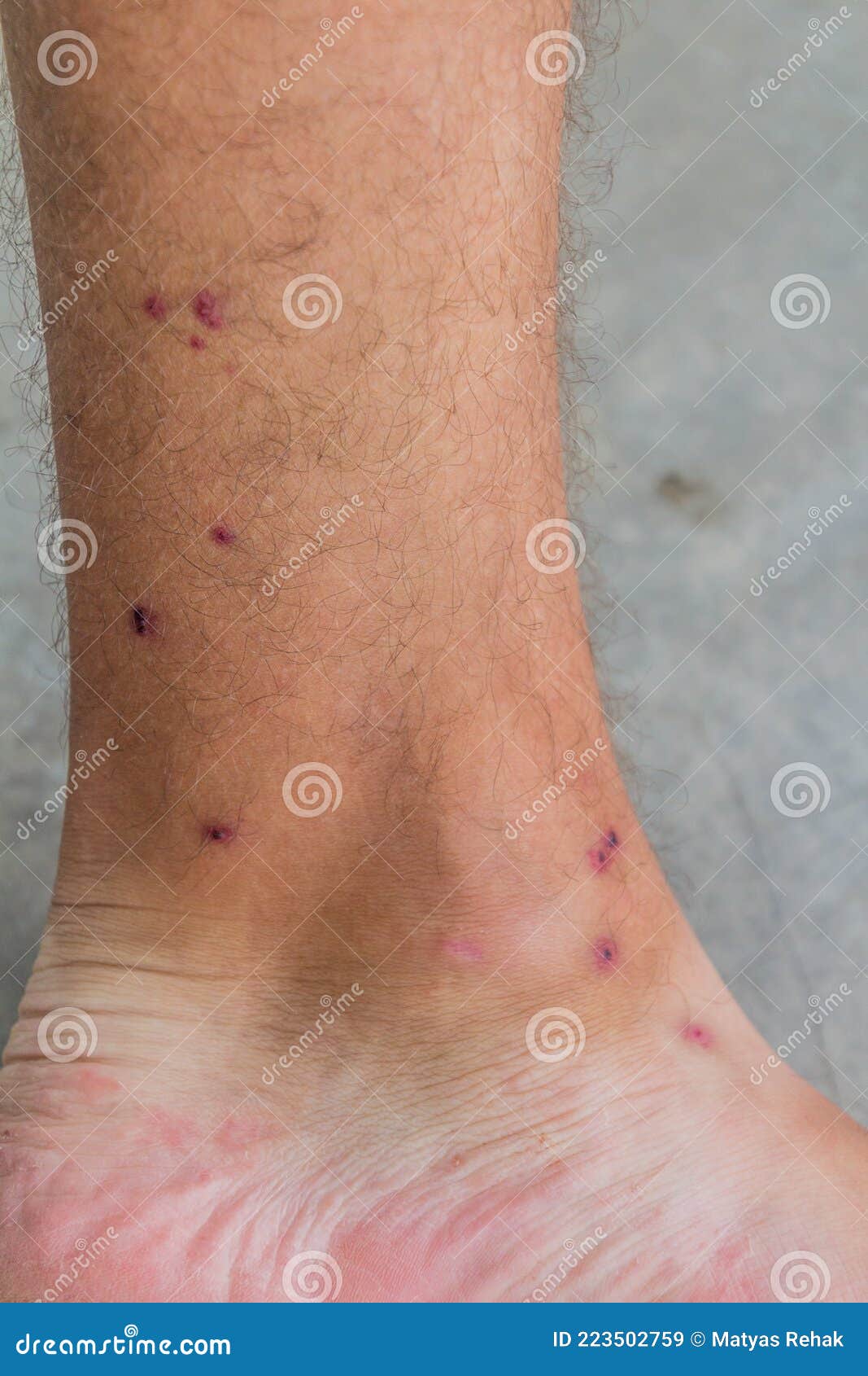 Human leg bitten by leech stock image. Image of human - 223502759