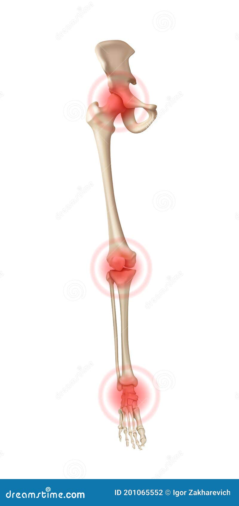 Human Leg Bones with Joints Affected by Arthritis Stock Vector ...