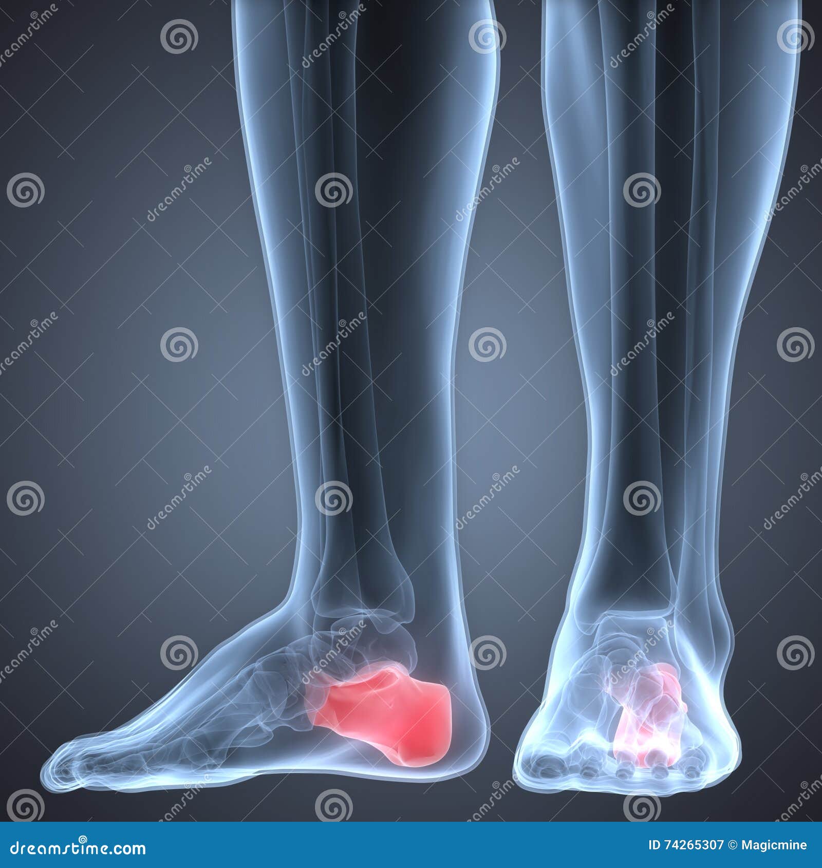 Human Leg Joint Pains (Calcaneus Bone) Stock Illustration ...