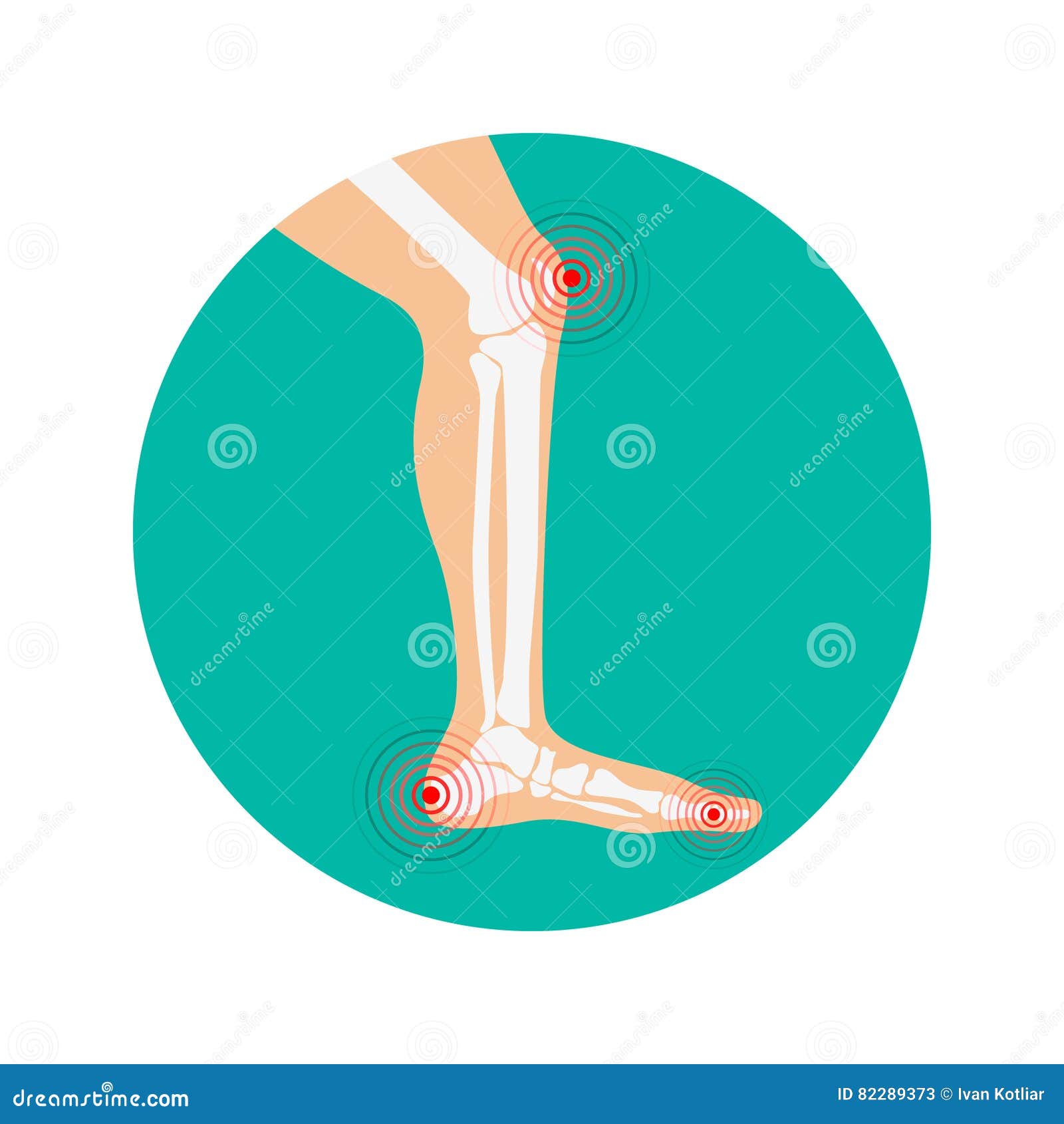 Human Leg Pain Zones. Design Elements for Infographic Stock Vector ...
