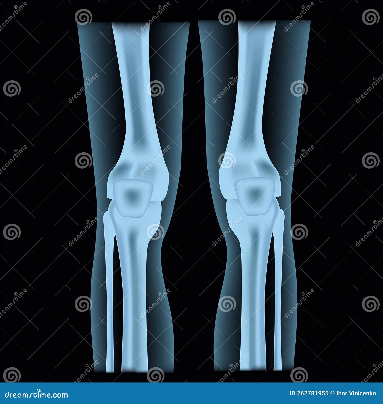 Human Legs in X-rays. Knee Joints Stock Vector - Illustration of ...