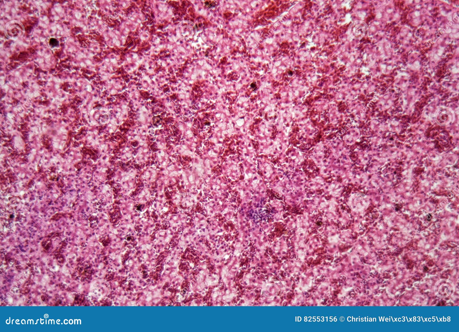 Human Liver Cells with Cancer Stock Photo - Image of metastasis, tumor ...