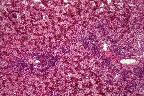 Human Liver Cells with Cancer Stock Image - Image of medicine, illness ...