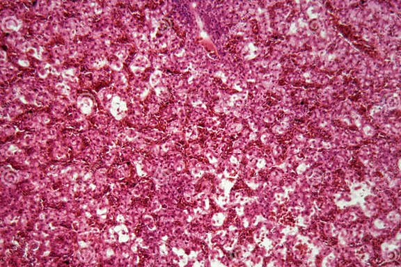 Human Liver Cells with Cancer Stock Image - Image of microscopic, cell ...