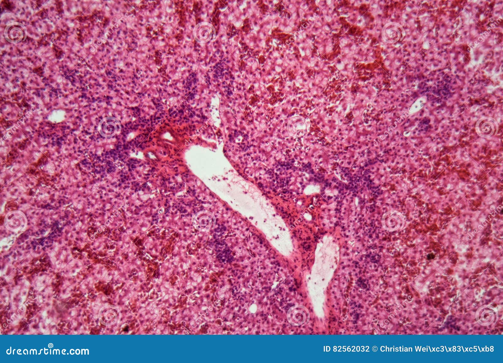 Human Liver Cells with Cancer Stock Photo - Image of medicine, death ...