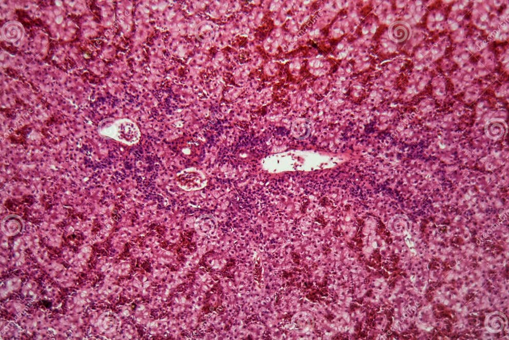 Human Liver Cells with Cancer Stock Image - Image of science ...