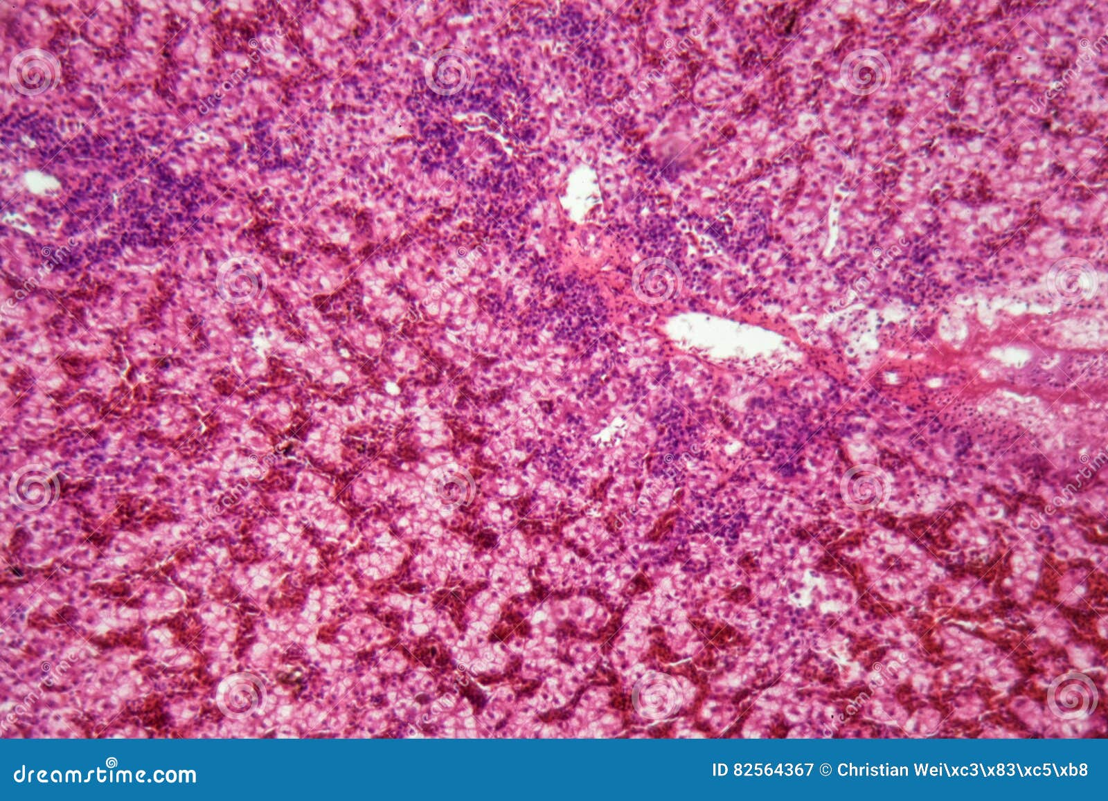 Human Liver Cells with Cancer Stock Image - Image of tumor, pharmacy ...