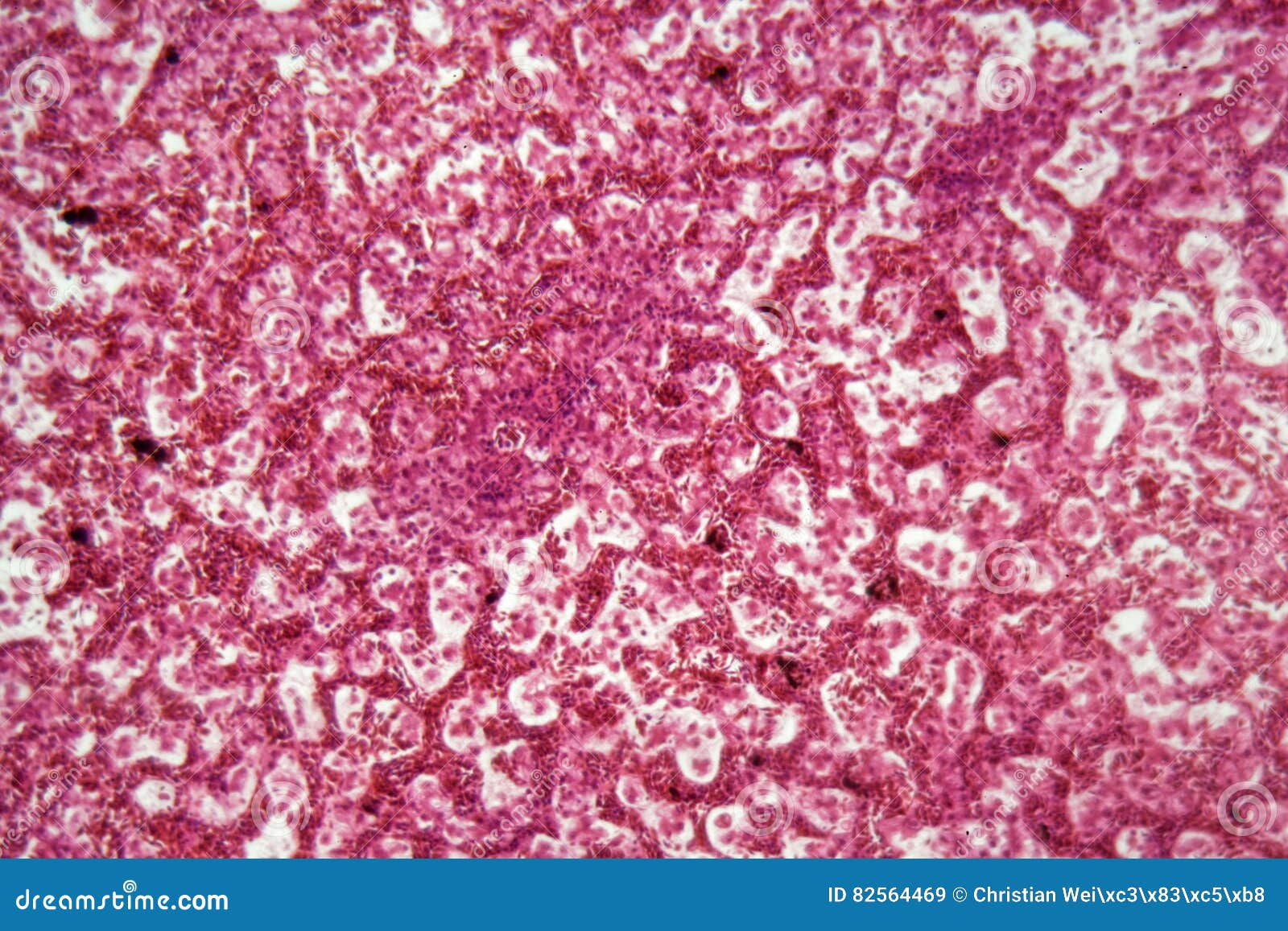 Human Liver Cells with Cancer Stock Image - Image of micro, anatomy ...