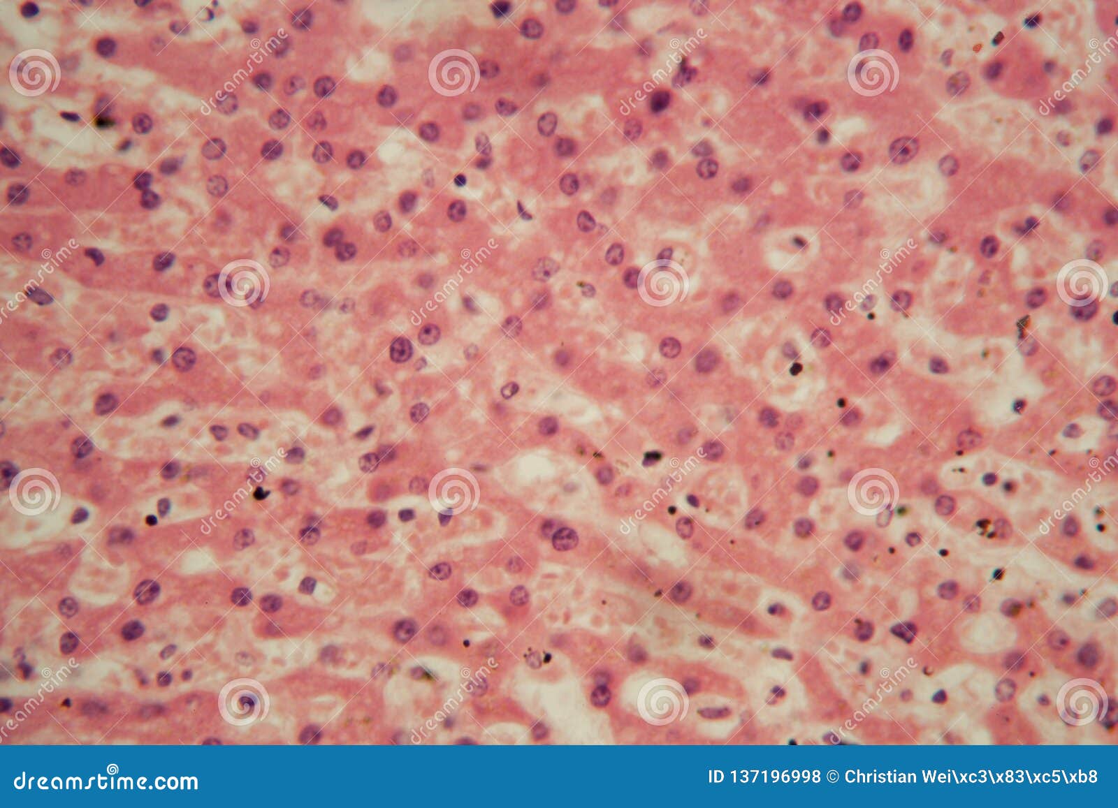 Human Liver Cells with Tuberculosis Under the Microscope Stock Photo ...