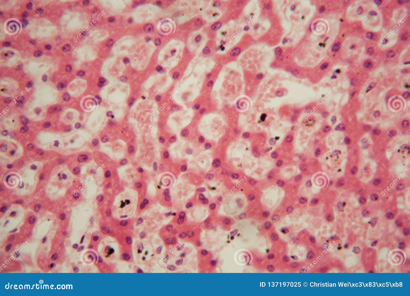 Human Liver Cells with Tuberculosis Under the Microscope Stock Image ...