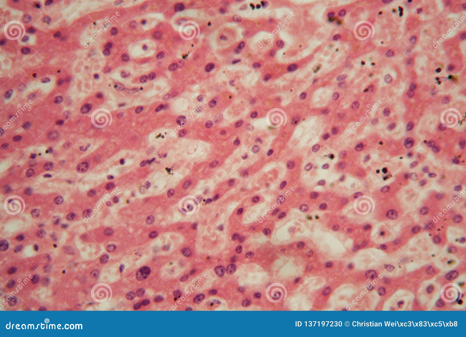 Human Liver Cells with Tuberculosis Under the Microscope Stock Photo ...