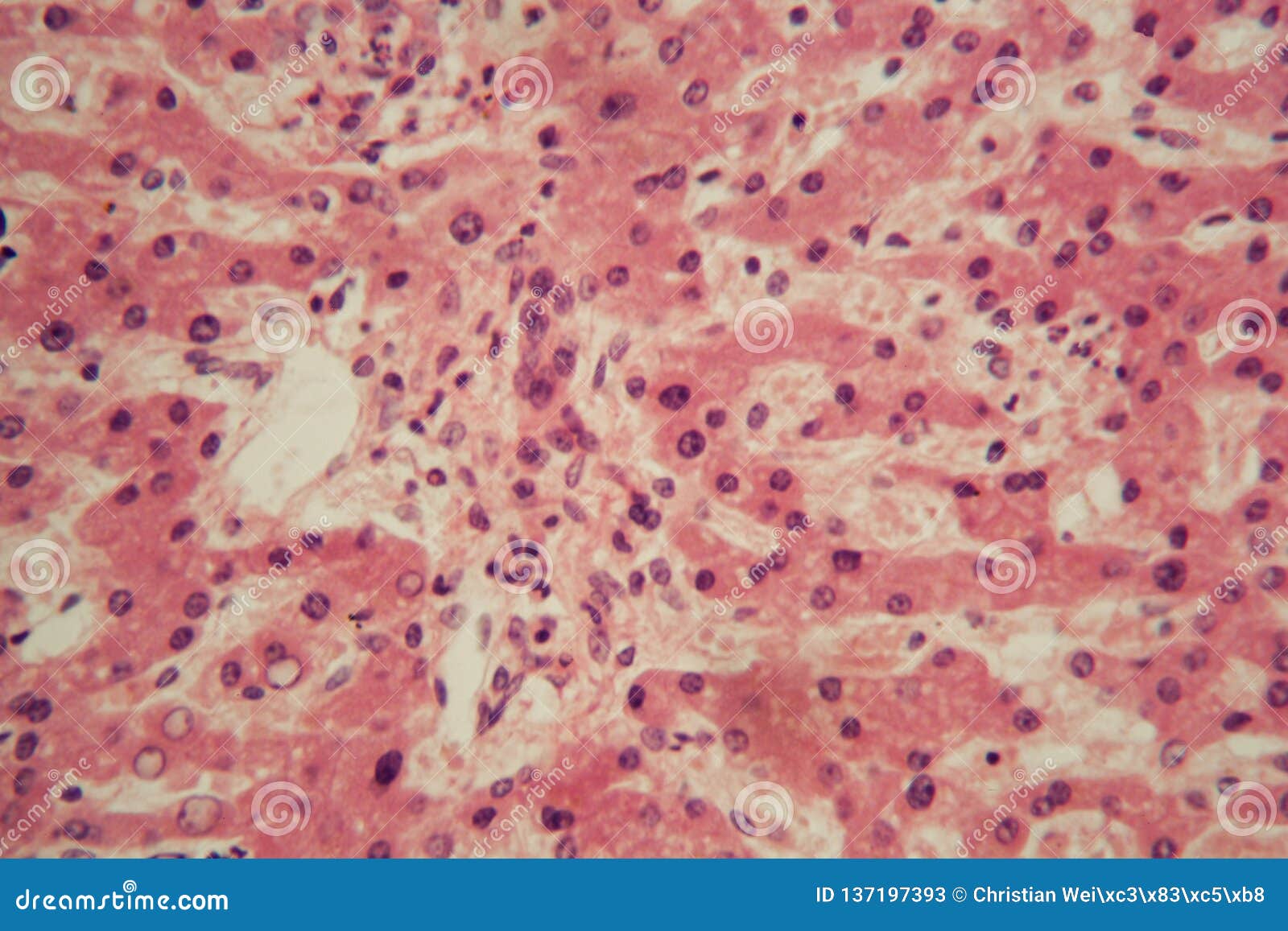 Human Liver Cells with Tuberculosis Under the Microscope Stock Image ...