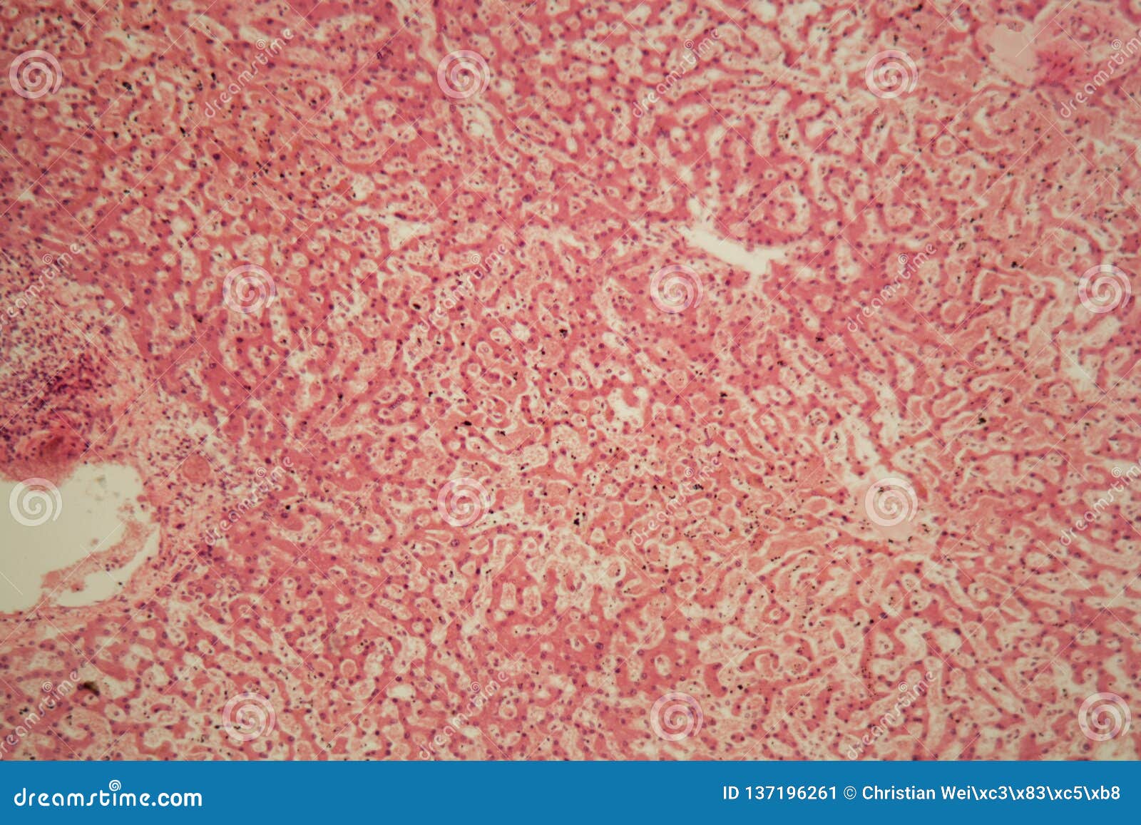 Human Liver Cells with Tuberculosis Under the Microscope Stock Image ...