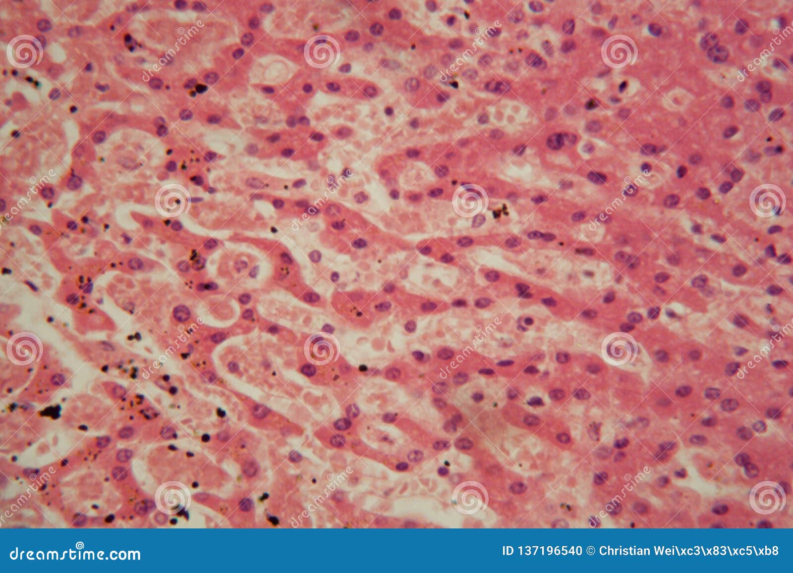 Human Liver Cells with Tuberculosis Under the Microscope Stock Photo ...