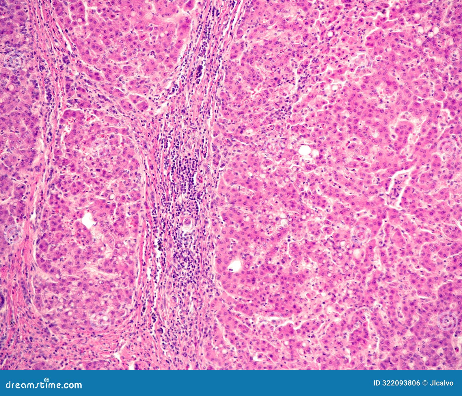 Human liver. Cirrhosis stock photo. Image of eosin, haematoxylin ...