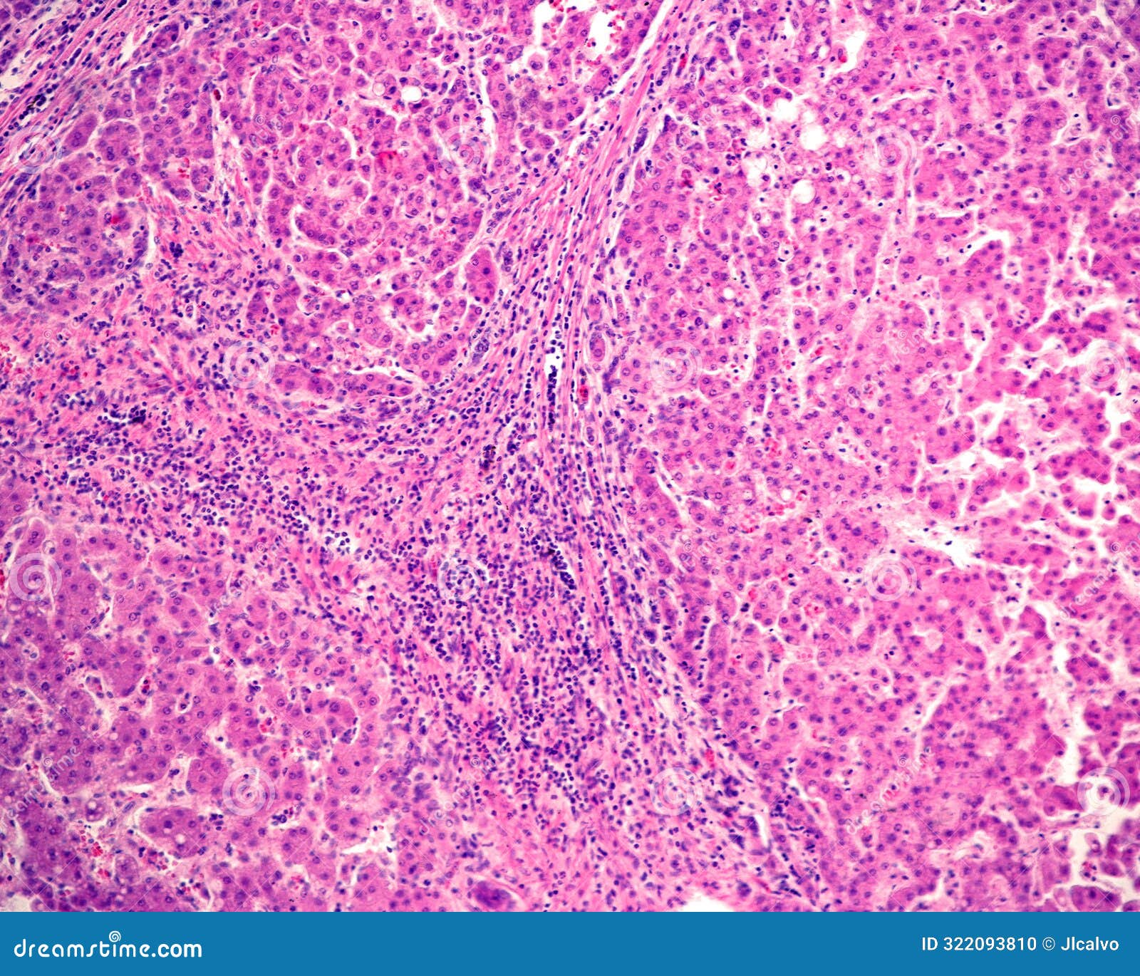 Human Liver. Cirrhosis Stock Photo | CartoonDealer.com #322093810