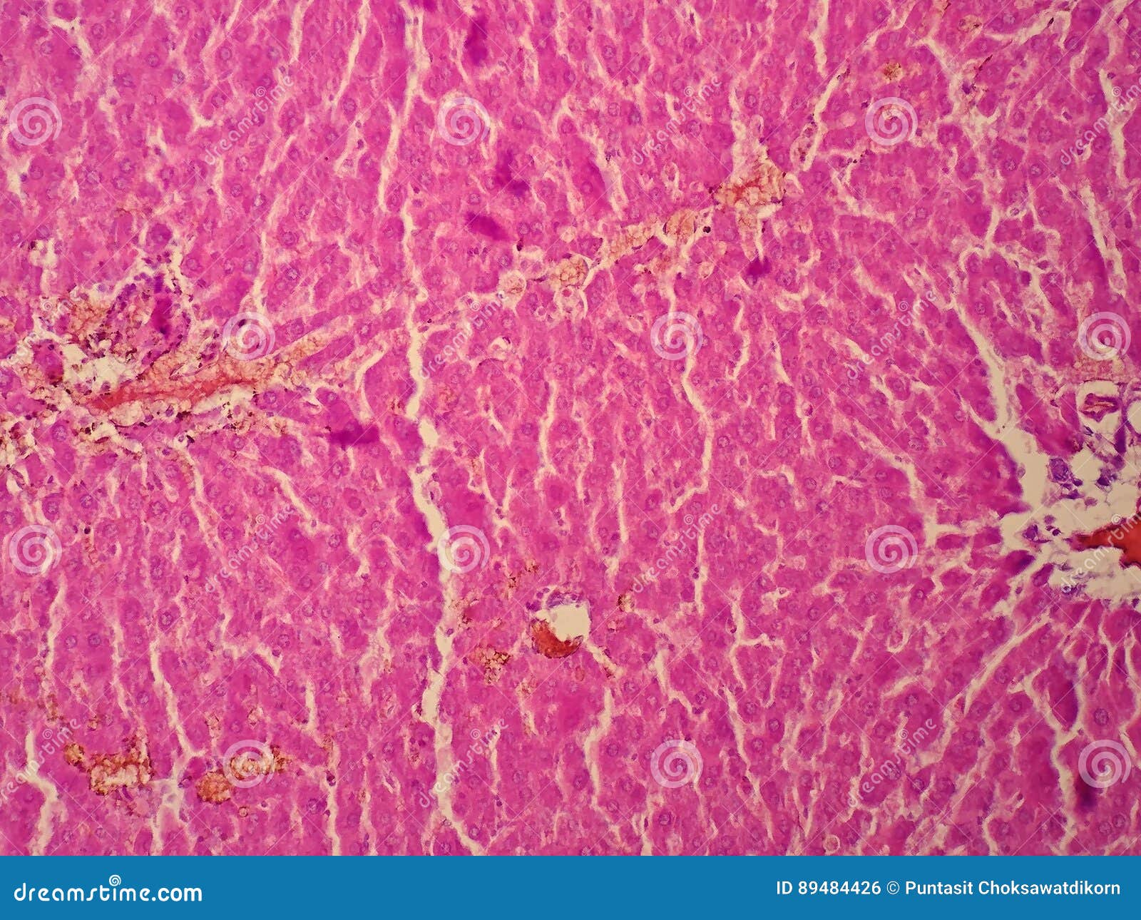 Liver SOL Cytology Showing Non Hodgkin Lymphoma. Metastatic Carcinoma ...