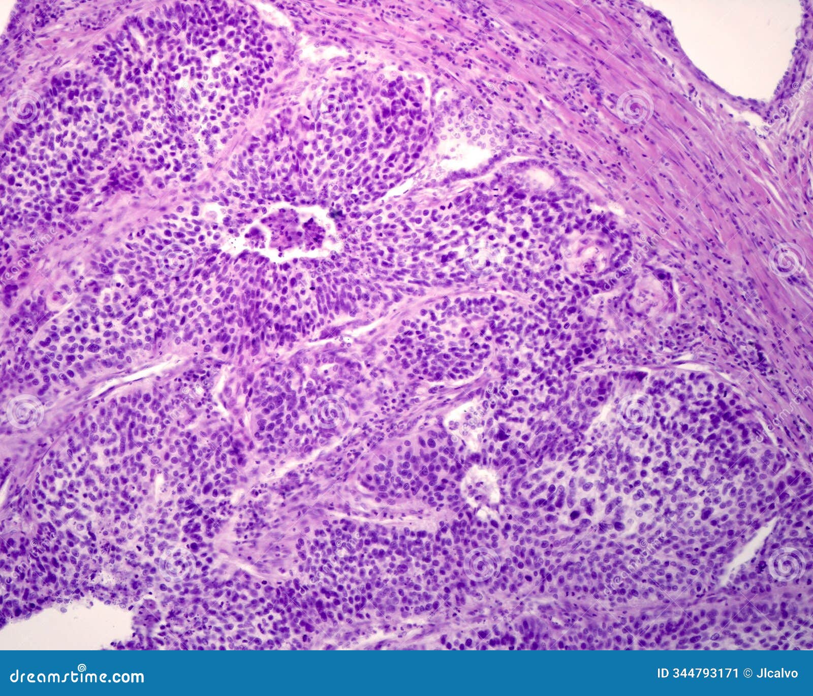 Human lung carcinoma stock image. Image of necrosis - 344793171