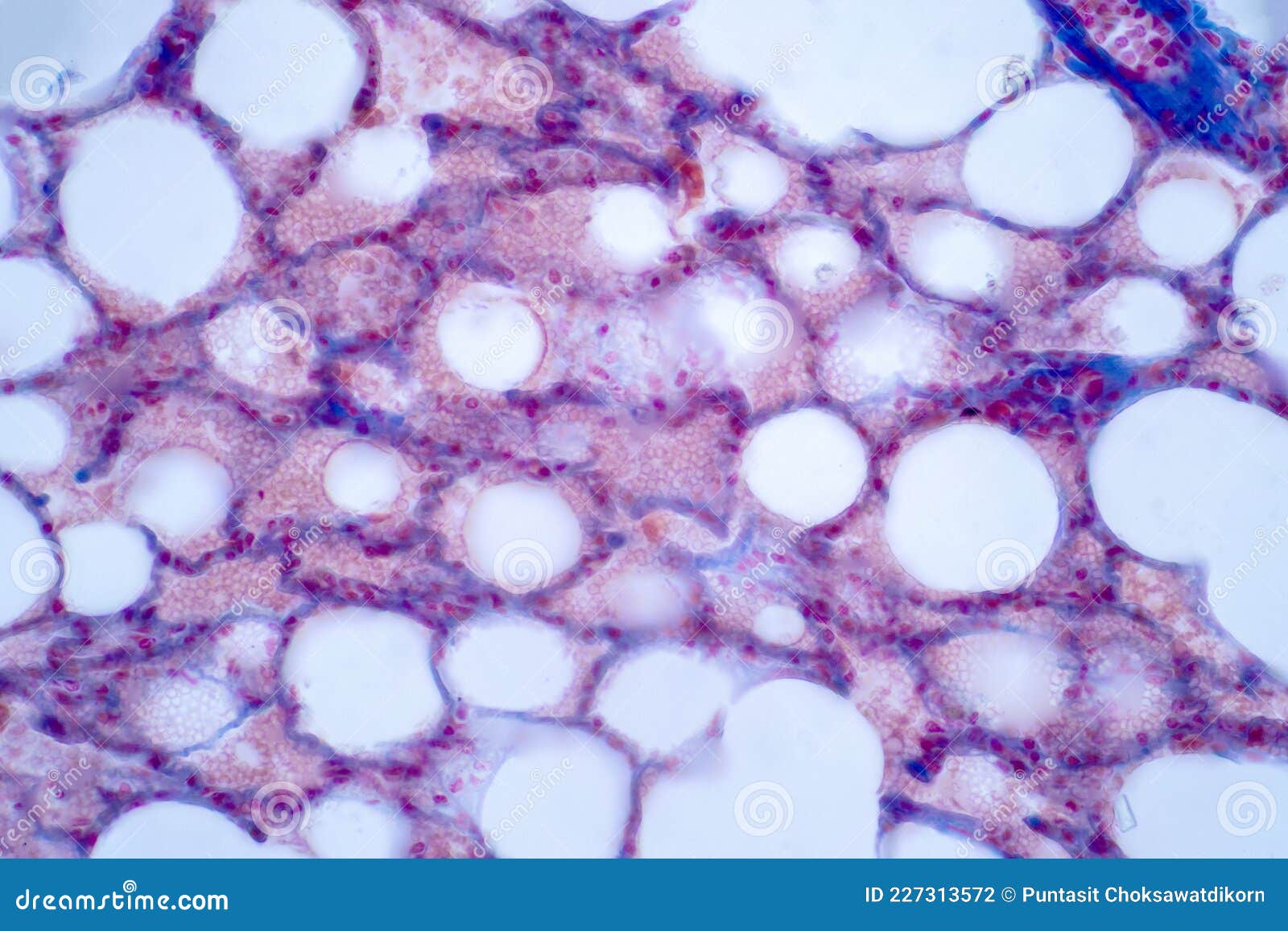 Human Lung Pathology Under Light Microscope Stock Photo - Image of ...
