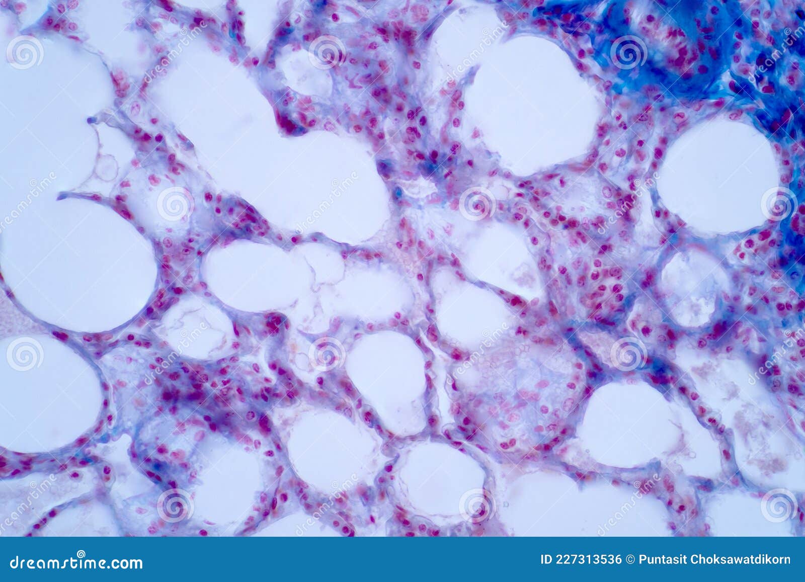Human Lung Pathology Under Light Microscope Stock Photo - Image of ...