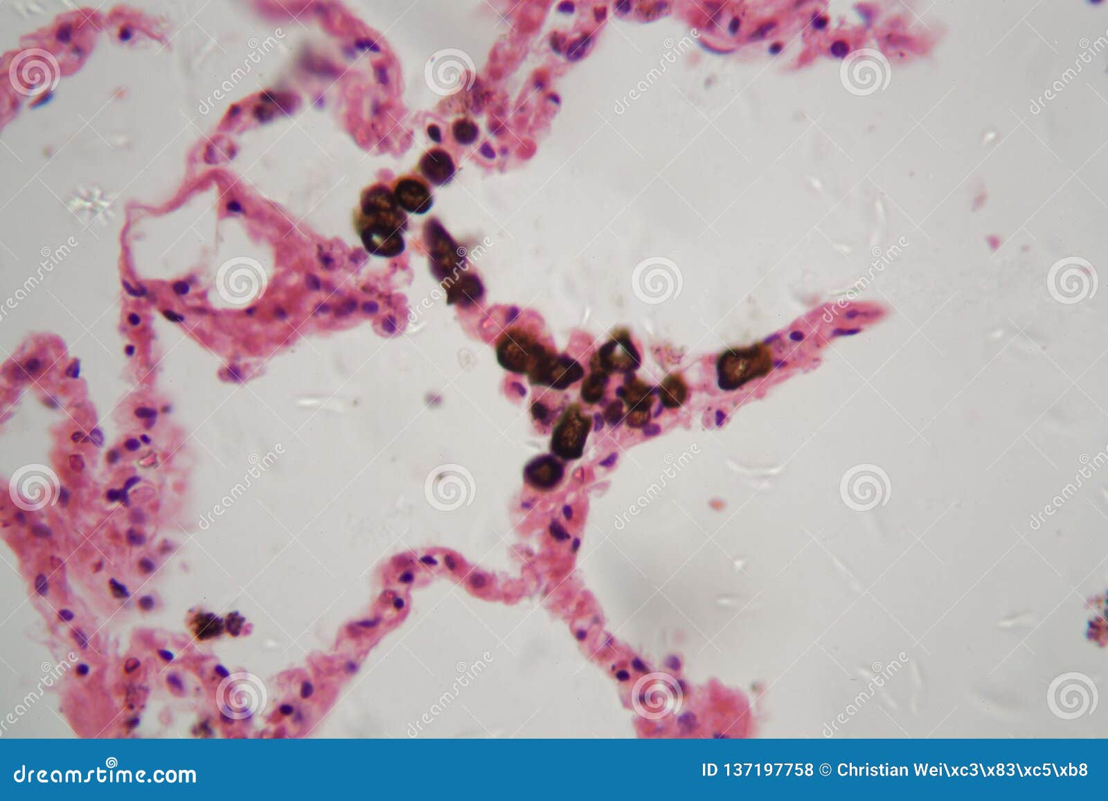 Human Lung Tissue with Dust and Coal Particles Under the Microscope ...