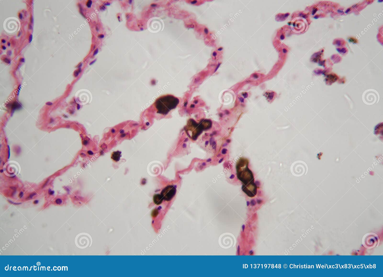 Human Lung Tissue with Dust and Coal Particles Under the Microscope ...