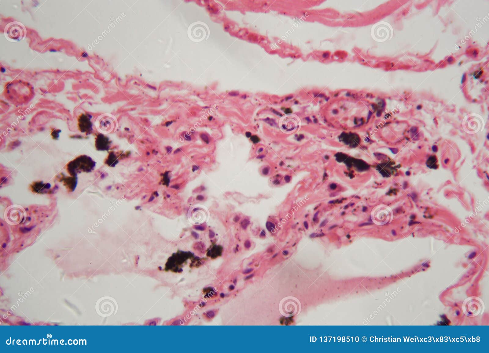 Human Lung Tissue with Dust and Coal Particles Under the Microscope ...