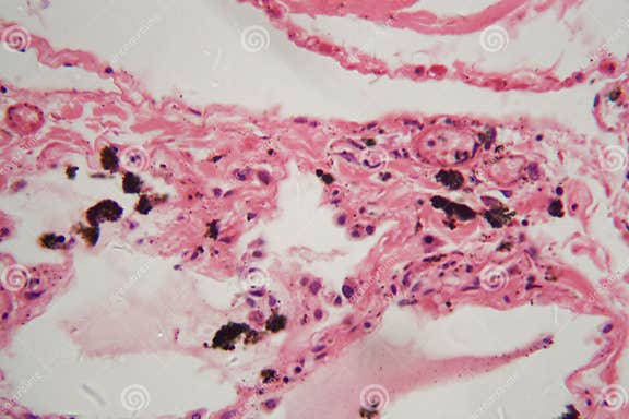 Human Lung Tissue with Dust and Coal Particles Under the Microscope ...